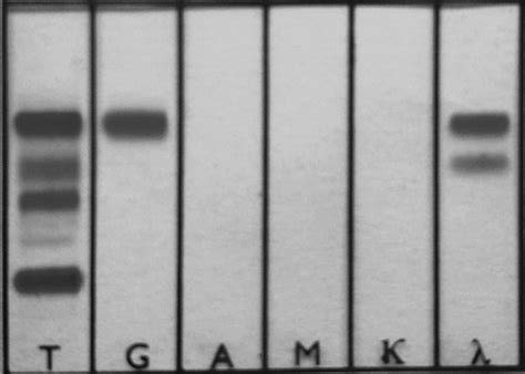 Excess Free Light Chains In Serum Immunofixation Electrophoresis