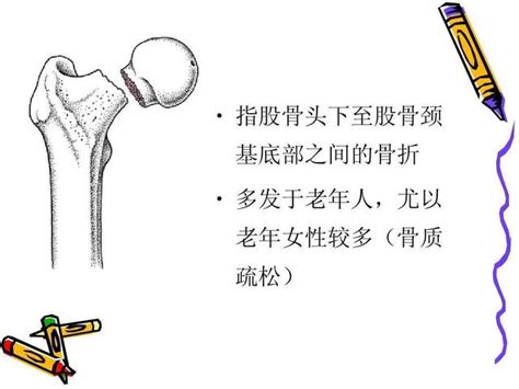 老年人發生股骨頸骨折，專家建議選擇西醫手術，不建議中醫正骨 每日頭條