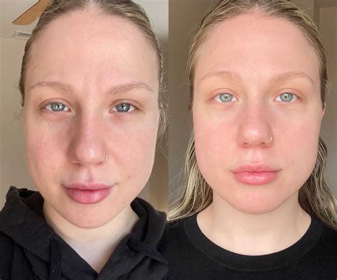 Red Light Therapy Wand Face Wands Solawave In 2022 Red Light