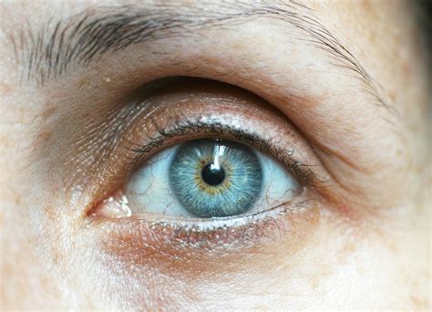 Eyelid Party Gone Wrong Say Goodbye To Blepharitis Feel Eye Comfort