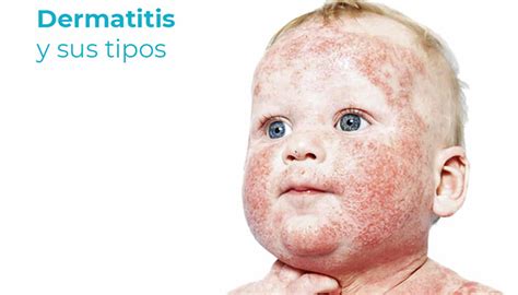 Dermatitis Y Sus Tipos Ccm Consultas