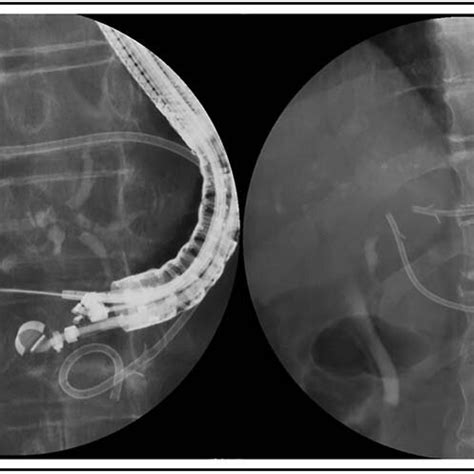 On The 71st Day After Cholecystectomy Endoscopic Ultrasound Guided Download Scientific Diagram