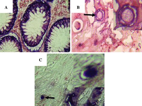 Double Immunohistochemistry For Epcam High Cd44 Cells Showing A