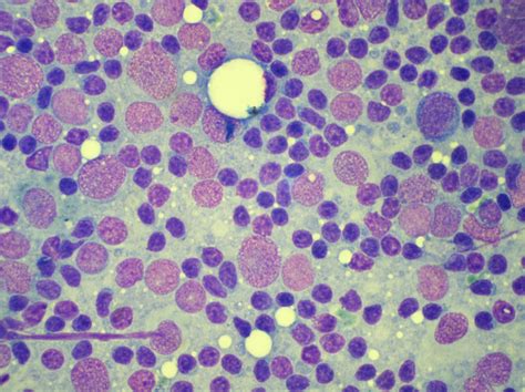 Aspiration Cytology Smear Of A Case Of Lymphoblastic Lymphoma Showing