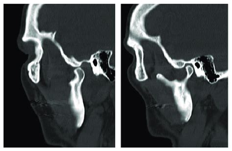Temporomandibular Joint Dislocation