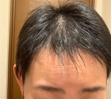 発毛／抗がん剤終了から2ヶ月 34歳子宮頸部小細胞癌になりました
