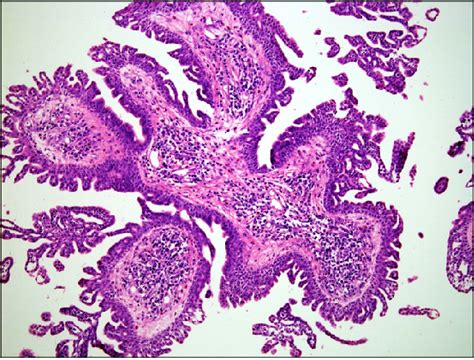 Endobrochial Biopsied Tissue Reveals Papillary Fronds Lined By