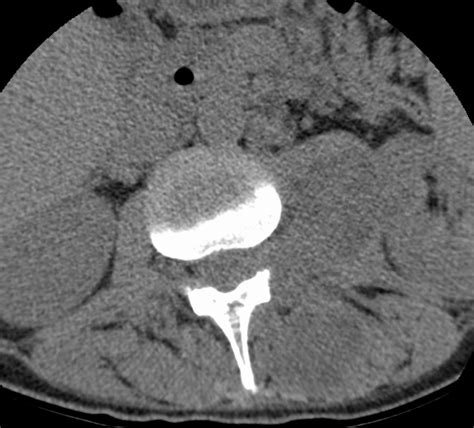 Psoas Abscess Mri