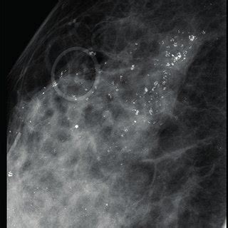 Images After Completion Of NAC In A 45 Year Old Woman With Human Download Scientific Diagram