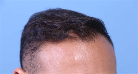 My Incredible Hair Transplant With Dr Parsa Mohebi Hair Transplant