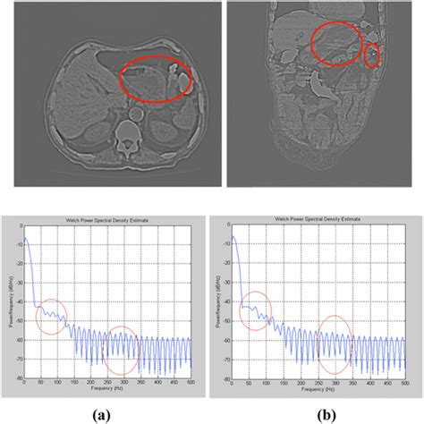 Unsharp Masking Results A Obtained Image Ct Image From The Above