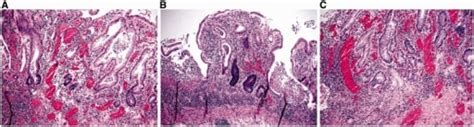 Ulcerative Colitis Humpathcom Human Pathology Pdf For The® Usmle