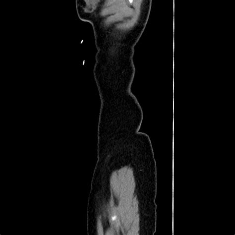 File Crohns Disease Terminal Ileitis Fistulizing Radiopaedia 98245