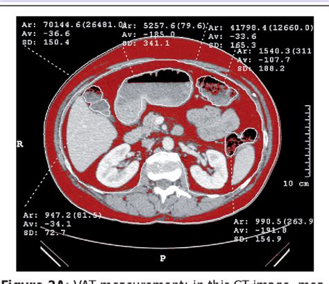 Figure 2 From The Effect Of Falsely Highlighted Intestinal Intraluminal