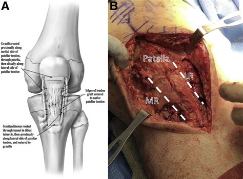 Patellar Tendon Posterior Cruciate Ligament Injuries Zehr Center