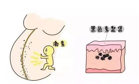 孕妇肚子上为什么会有一条线