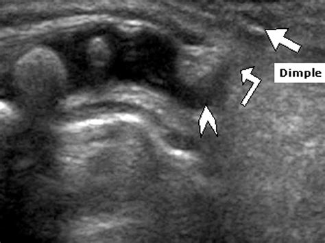 sonography of the neonatal spine part 1 normal anatomy imaging pitfalls and variations that