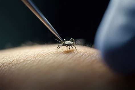 Removing A Tick From Human Skin With Tweezers Close Up Of Tick Bite