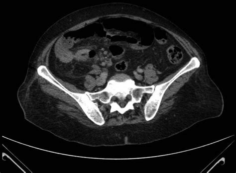 Multisystemic Tuberculosis Presenting With Scrofula Intestinal And