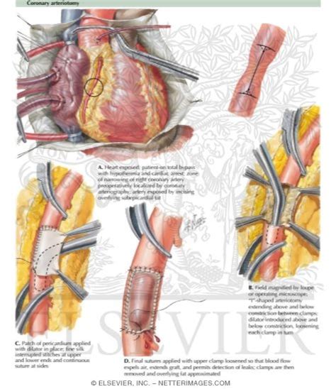Patch Graft Reconstruction