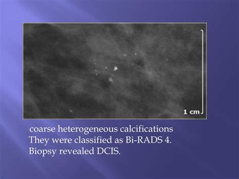Ppt Breast Calcifications Differential Diagnosis And Birads