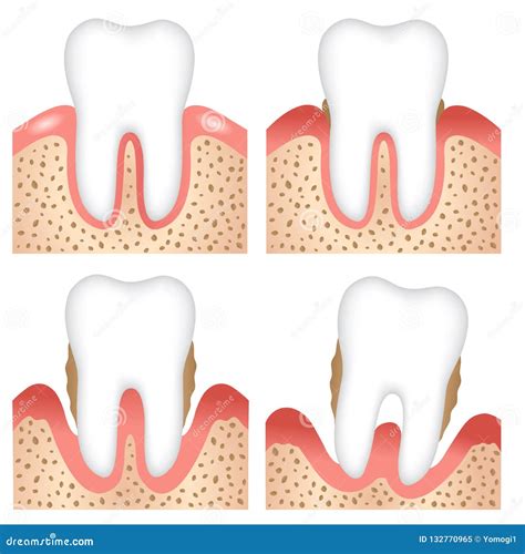 Stages Of Gum Disease Infographic Illustration Dental And Oral Care