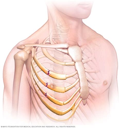 Fracturas de costilla Síntomas y causas Mayo Clinic