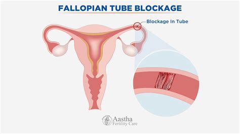 Fallopian Tube Blockage Signs And Symptoms You Should Never Ignore