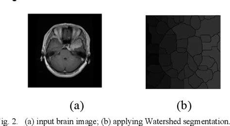 Figure 2 From Brain Tumor Classification Using Watershed Segmentation With Ann Classifier
