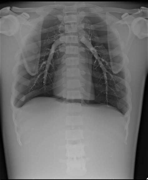 Lung And Chest Phantom Radiology Support Devices Inc