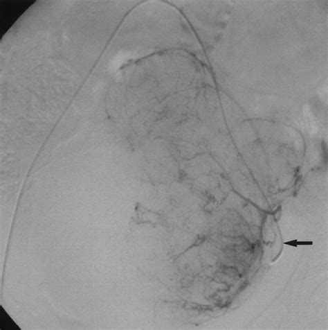 Emergency Selective Arterial Embolization For Control Of Life