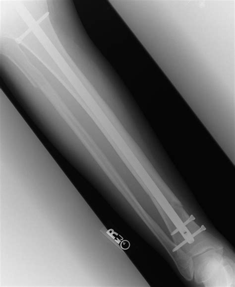 Broken Leg Xrayseries 3 Free Photo Download Freeimages