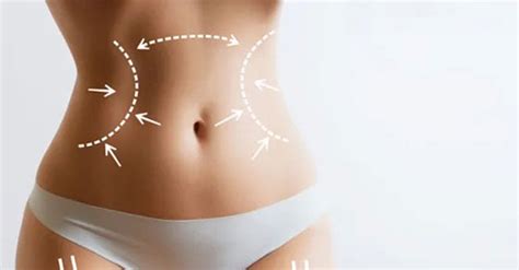 Managing Post Operative Lymphatic Congestion Following Liposuction
