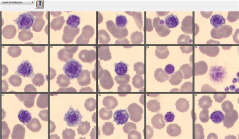 Large Platelets On Smear