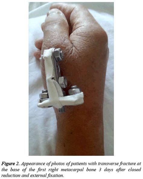 Two Year Follow Up Of Closed Reduction And External Fixation Treatment