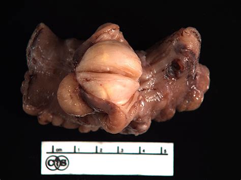 Pathology Outlines Calcifying Fibrous Tumor