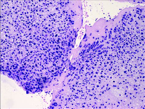 Subintimal Proliferation Of Cells In A Focally Myxoid Stroma H And E