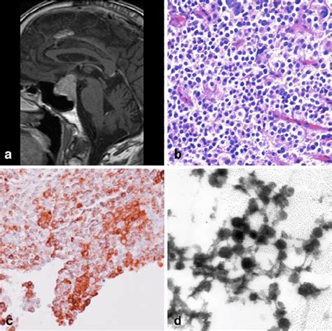 Case 1 Images A Contrast Enhanced Sagittal T1 Weighted Mri Tse