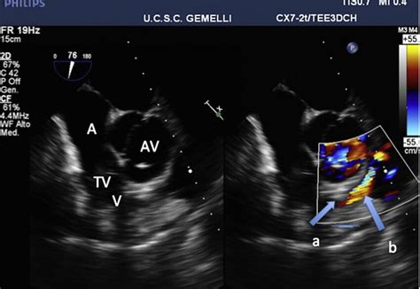Mid Esophageal Short Axis View Showing Severe Dynamic Obstruction Of