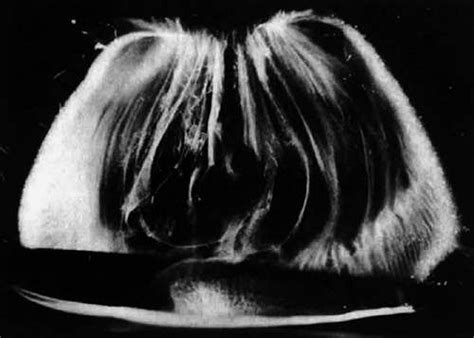 Surgical Anatomy Of Vitreous And The Vitreoretinal Interface Ento Key