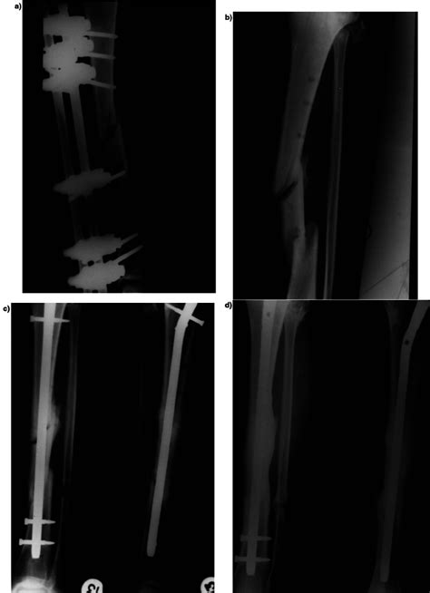 A Segmental Tibial Fracture Initial Treatment With External