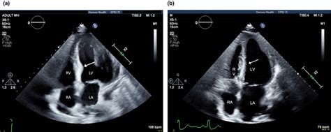Initial Transthoracic Echocardiotraphy A Demonstrates Basal Septal