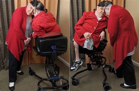 6 Oldest Living Conjoined Twins In The World