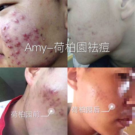 如何正确找到祛痘方法～ 痘印 脓包痘。淋巴痘。炎症痘。白头粉刺。黑头 都没问题。需要的话可以去看看哦 1489924840