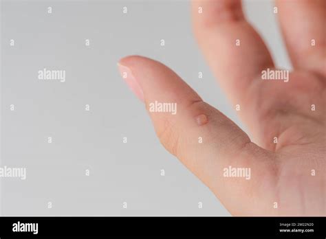 Wart On Hand The Concept Of Treating Warts And Other Skin Defects