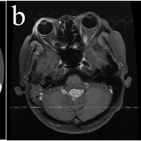 A Chest Ct Showing Large Patches And A Patchy Increased Density In