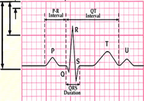 12 Lead Ekg Cct Exam Review Flashcards Quizlet
