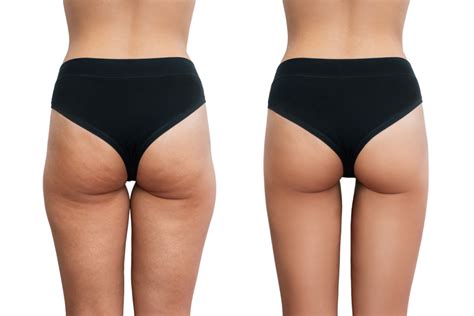 Non Surgical Bbl Results Recovery And Long Term Benefits Explained