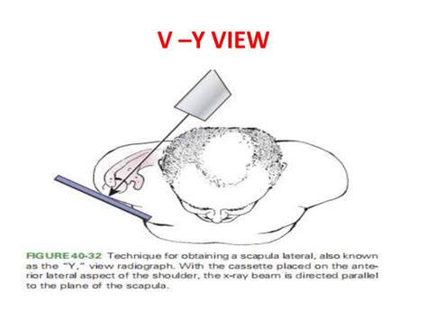 Neglected Shoulder Dislocation Management Pptx