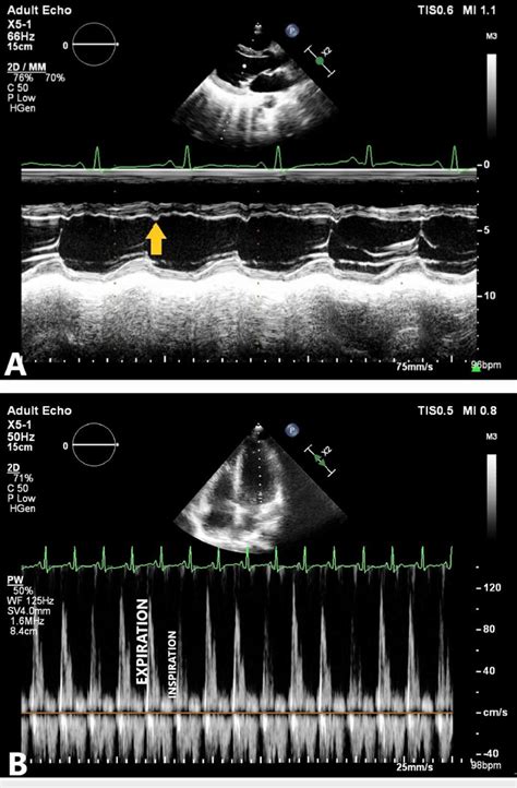 A M Mode Echocardiogram Recording Showing Abnormal Motion Of The